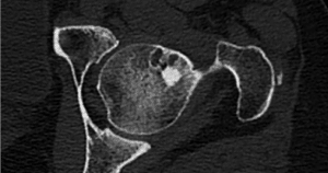 Quantification, métastase et énostose banale - Imosteo
